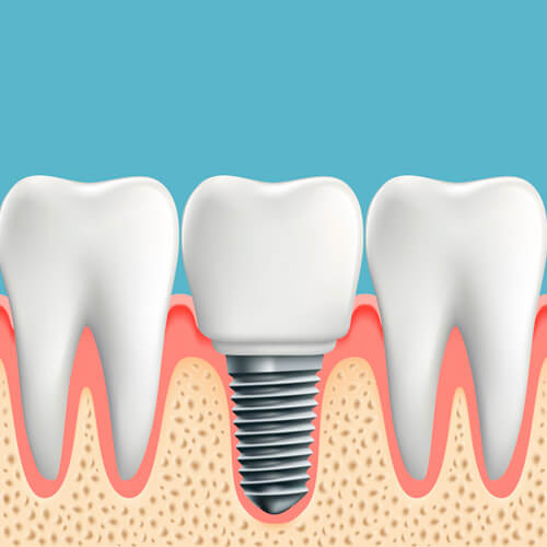 Qué es un implante - CLINICA DENTAL VIGO RIOSDENT